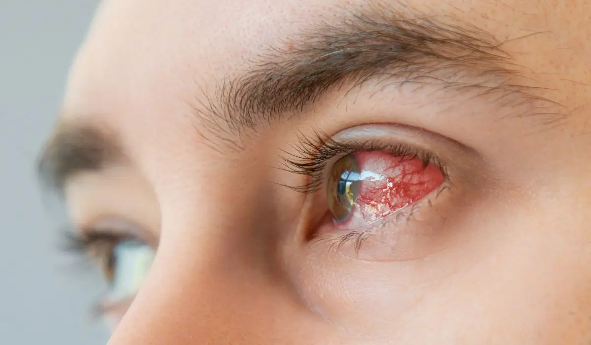 Red Spot on Your Eye? Causes, Risks & When to Act Fast